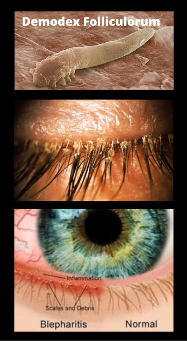 Demodex Blepharitis - Eye Care Solutions Demodex Blepharitis - Eye Care Solutions